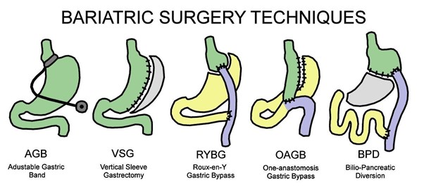 ADE | Bariatric Surgery for the Management of Type 2 Diabetes: A Review
